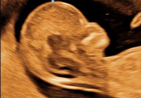 Obstétrico com Translucência Nucal - Clínica de Ultrassom Dra. Morgana ...