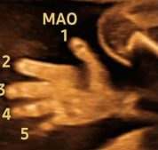 Morfológico do 2º Trimestre - Clínica de Ultrassom Dra. Morgana Kummer